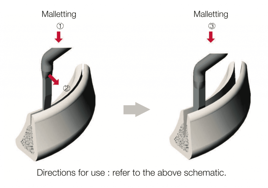 Blade holder: When it is difficult to incise bone using bur in case of ...